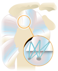 Regeneten LP - RediscoverYourGo with Smith & Nephew